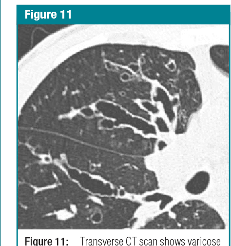 [PDF] Fleischner Society: glossary of terms for thoracic imaging ...