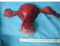 Figure 1 from Multiple and large nabothian cysts: a case report Çok ...