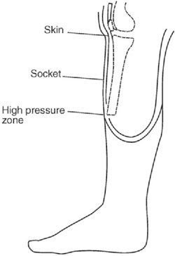 Figure 3 from Skew flap technique in trans-tibial amputation | Semantic ...