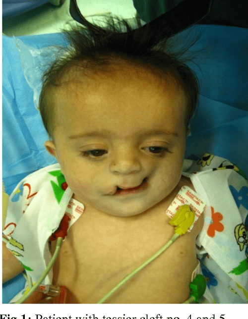 Figure 2 from A Bilateral Tessier Number 4 and 5 Facial Cleft and ...