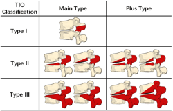 Figure 1 from Trans-intervertebral osteotomy classification of ...