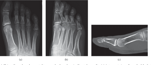 [PDF] Stenosing Tenosynovitis of the Flexor Hallucis Longus Tendon ...