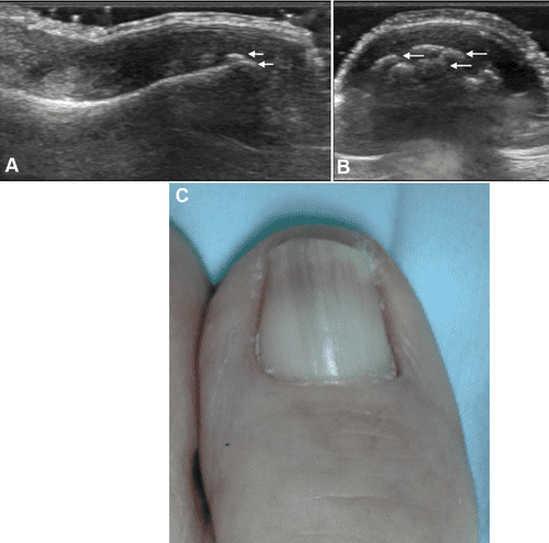Nail unit ultrasound: a complete guide of the nail diseases | Semantic ...