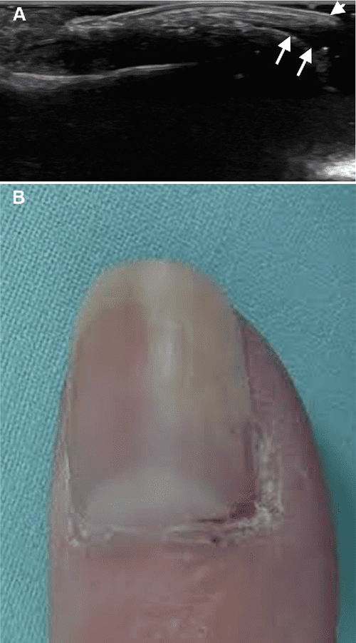 Nail unit ultrasound: a complete guide of the nail diseases | Semantic ...