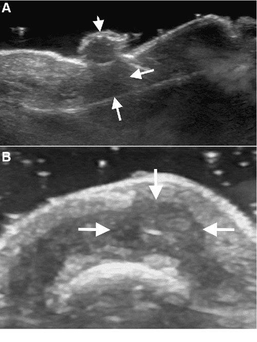 Nail unit ultrasound: a complete guide of the nail diseases | Semantic ...