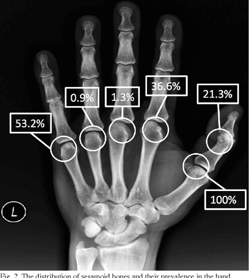 Figure 1 from Prevalence and Distribution of Sesamoid Bones of the Hand ...