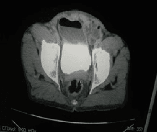 Figure 2 from Emphysematous Pyelonephritis and Cystitis Complicated by ...