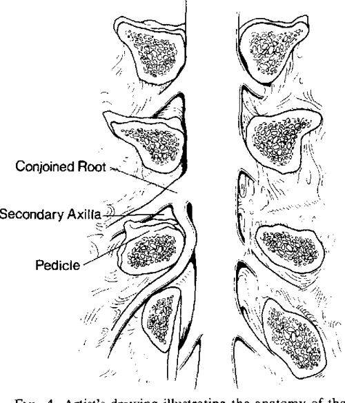 Figure 4 from Surgical treatment of 63 cases of conjoined nerve roots ...