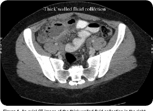 Figure 1 from CT guided percutaneous drainage of appendix abscess ...