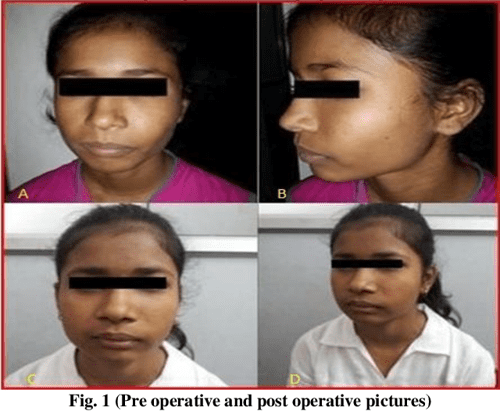 Figure 4 from Revisiting Midfacial Degloving Approach for Craniofacial ...