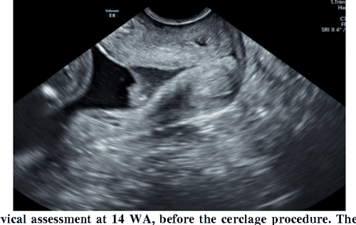 Figure 3 from DIGEORGE SYNDROME – IMPORTANCE OF THE EARLY FETAL ANATOMY ...