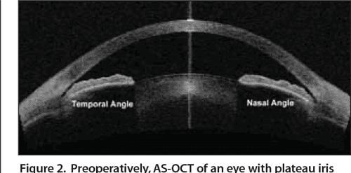 Figure 2 from Endocycloplasty A new technique for managing angle ...