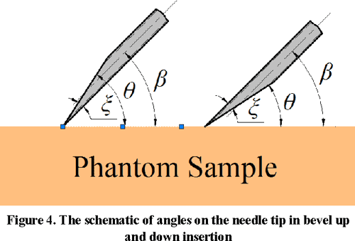 [PDF] Investigation of Needle Bevel Face Up and Down Orientation on ...