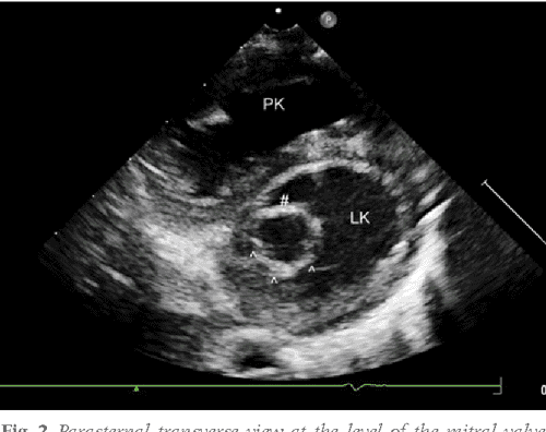 Figure 8 from Supravalvar mitral ring with a parachute mitral valve and ...