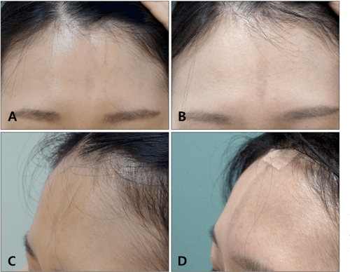 Figure 2 From Treatment Of Linear Morphea En Coup De Sabre With Micronized Acellular Dermal