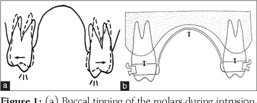 [PDF] Modified Transpalatal Arch for Molar Intrusion | Semantic Scholar