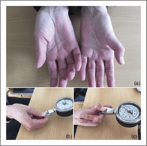 Correction of Z-deformity of the thumb after trapeziectomy by modified ...