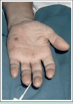 Osler's nodes and Janeway lesions. | Semantic Scholar