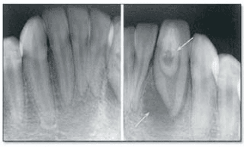 Figure 1 from Dens invaginatus on a geminated tooth: a case report ...