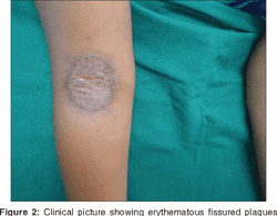 Figure 3 from Acrodermatitis Enteropathica in an adult: a case report ...