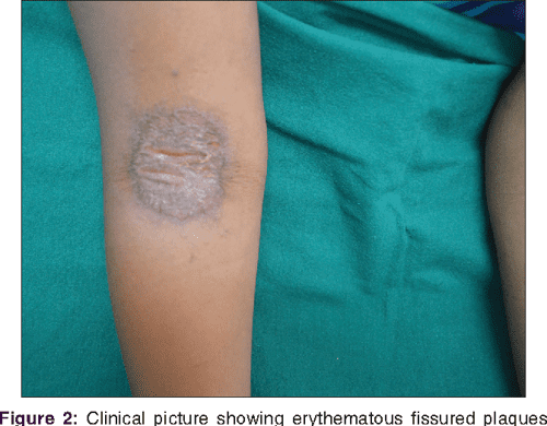 Figure 1 from Acrodermatitis Enteropathica in an adult: a case report ...