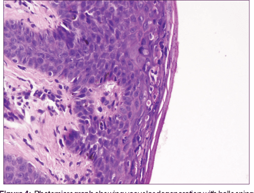 [PDF] Acrodermatitis Enteropathica in an adult: a case report ...