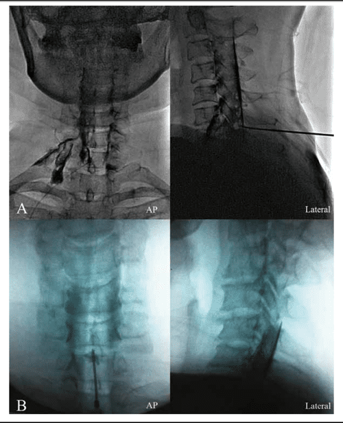 Table 1 from Randomized Controlled Study of Percutaneous Epidural ...
