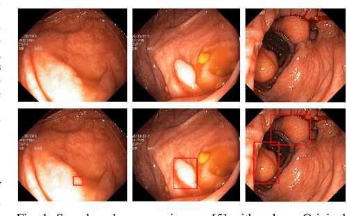 Figure 1 from Polyp Detection in Colonoscopy Images using Improved ...