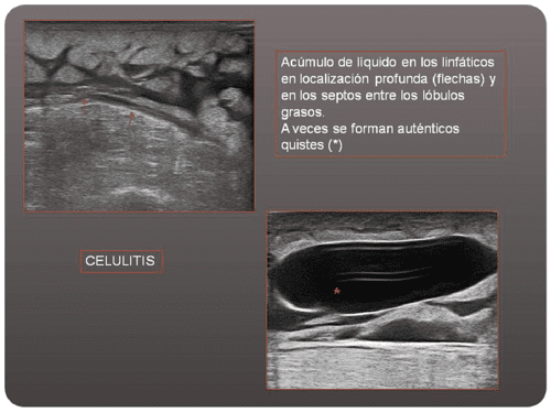 Figure 7 from Patología de la grasa subcutánea. Utilidad del examen ...