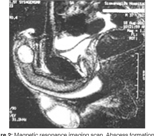 Figure 3 from A case of cavernosal abscess after neglected penile ...