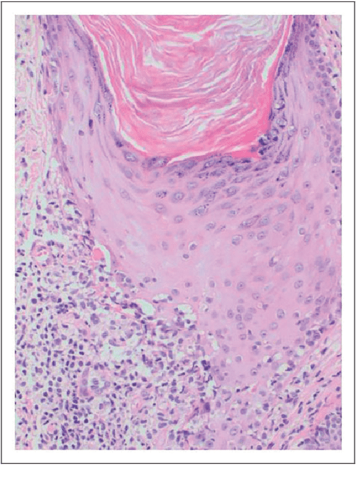 Chronic cutaneous lupus erythematosus presenting as atypical acneiform ...