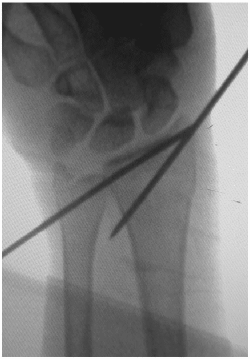 Figure 1 from Management of distal radius fractures – A new concept of ...