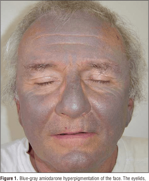 Figure 2 from Photodistribution of blue-gray hyperpigmentation after ...
