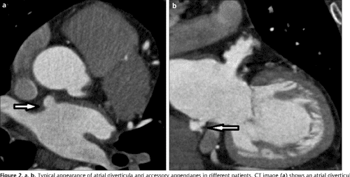 Figure 4 from The incidence of left atrial diverticula in coronary CT ...