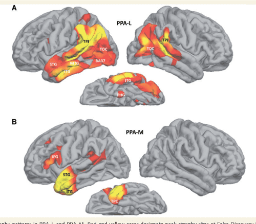 Table 1 from Quantitative classification of primary progressive aphasia ...