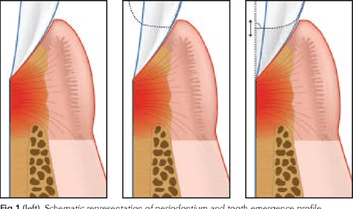 Table 2 from Clinical Periodontal Response to Anterior All-Ceramic ...