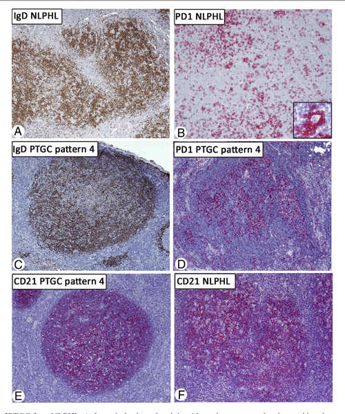Figure 2 from Immunoarchitectural patterns of progressive ...