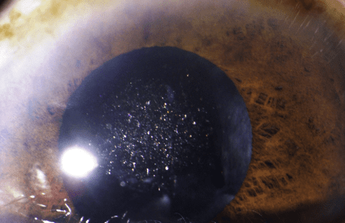 Figure 1 from Multimodal imaging of glistening IOL | Semantic Scholar