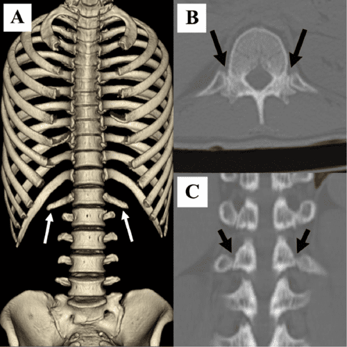 The association between lumbar rib and lumbosacral transitional ...