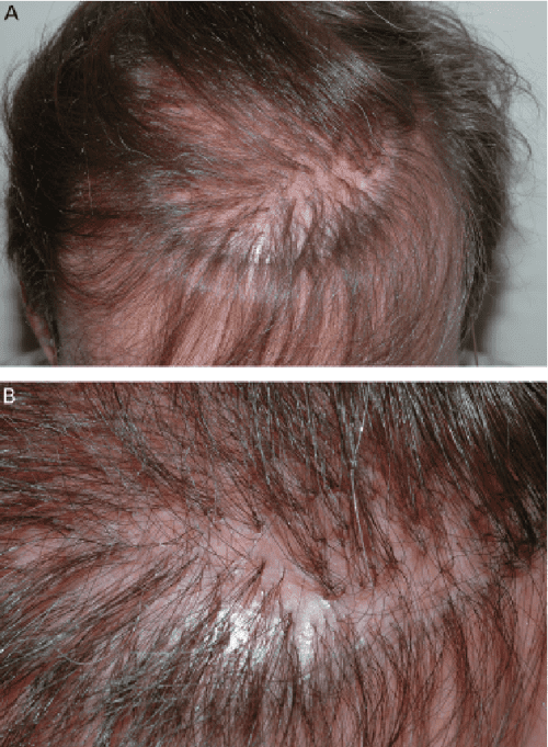 Figure 1 from Folliculitis decalvans developing 20 years after hair ...