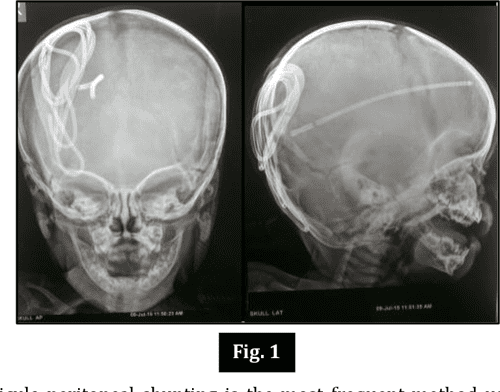 SUBGALEAL MIGRATION OF THE DISTAL CATHETER OF A VENTRICULOPERITONEAL ...
