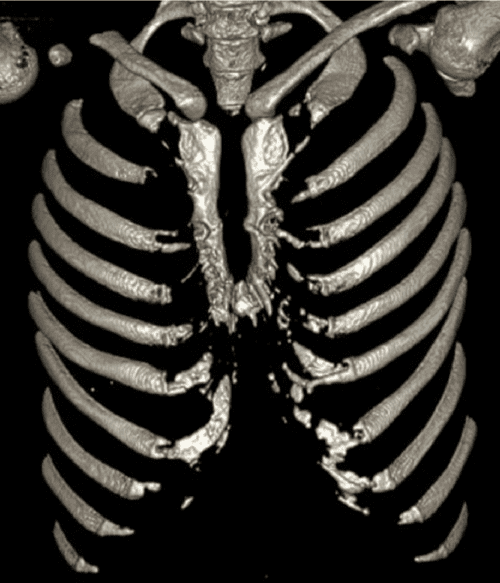 Figure 13 from Congenital anomalies of sternum: Pre and postnatal ...
