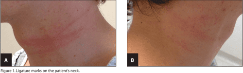 Table 1 from Distinguishing Suicidal Attempt from Autoerotic ...