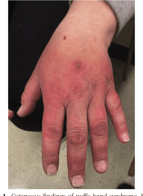 Puffy hand syndrome secondary to intravenous drug use presenting in ...
