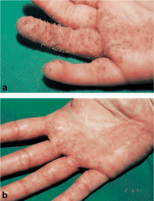 Figure 1 from Long-term involution of unilateral porokeratotic eccrine ...