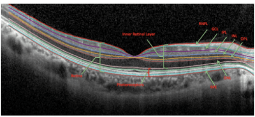 Figure 1 from Macular Retinal Layer Thickness and Associated Factors ...