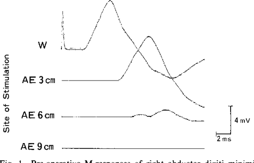Figure 4 from High Ulnar Nerve Palsy Caused by the Arcade of Struthers ...