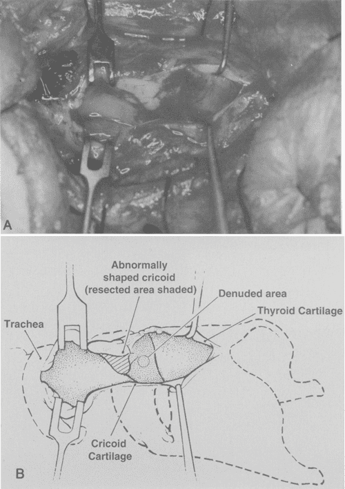 One-Stage Repair of Congenital Laryngeal Webs | Semantic Scholar