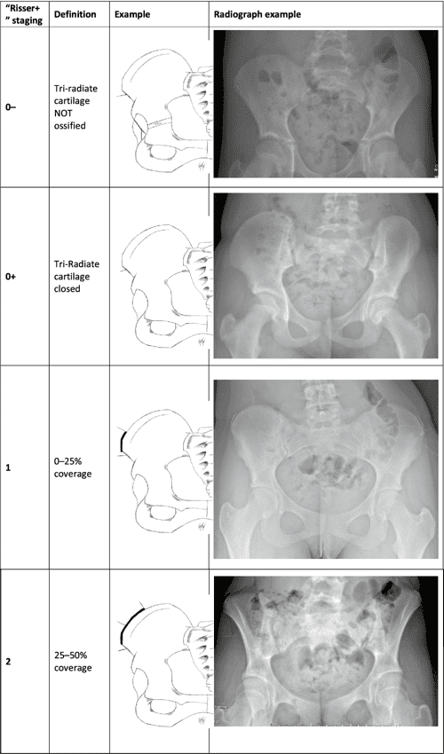 Table 1 from The “Risser+” grade: a new grading system to classify ...