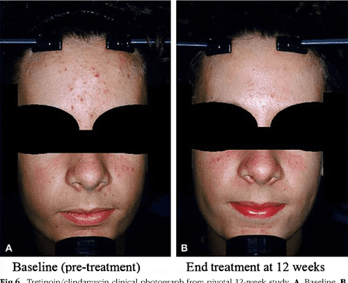 Figure 1 from New insights into the management of acne: an update from ...